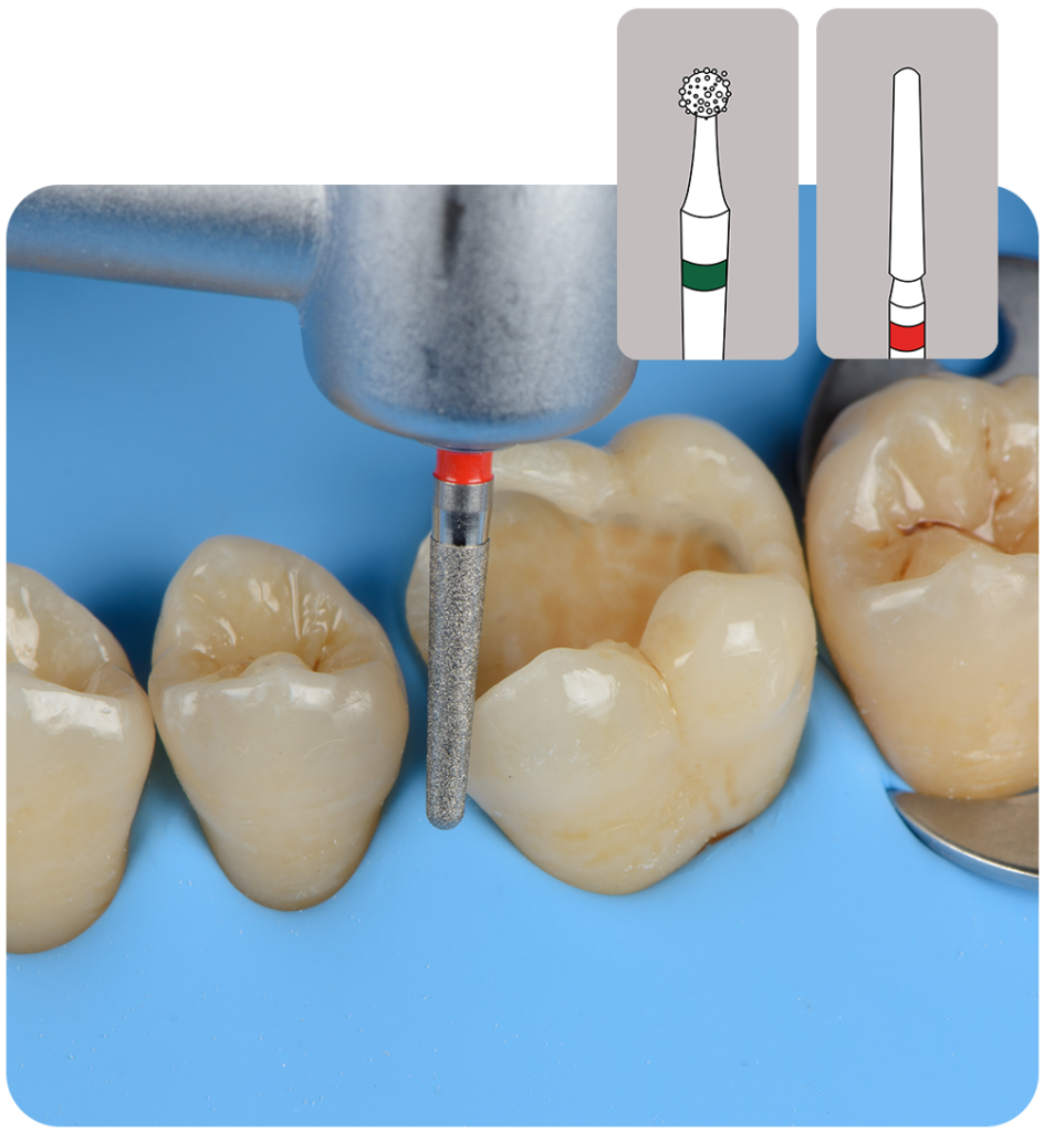 Indirect restorative – Preparation – campaigns-gceurope